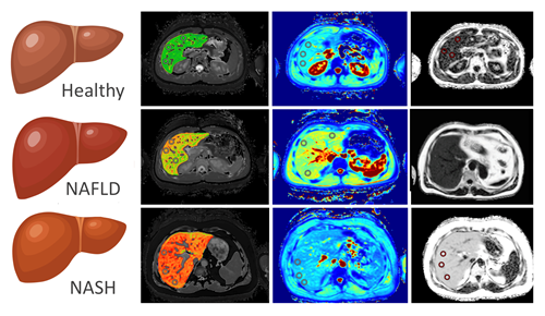 First European guidance on the use of multiparametric MRI in fatty ...