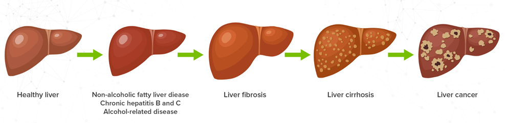 Quantitative MRI; a game changer for identifying the chronic liver ...