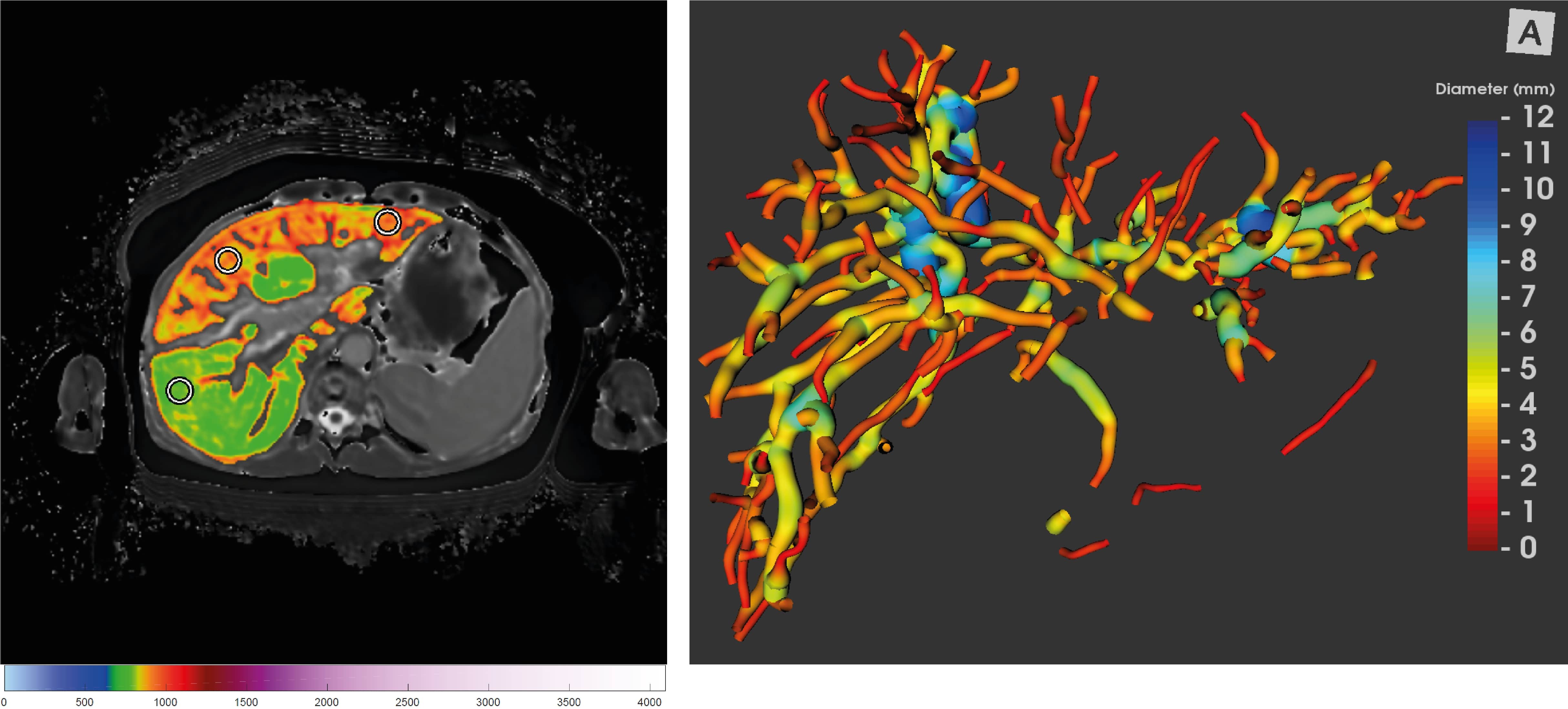 Revolutionizing diagnostics in autoimmune liver disease with Perspectum ...