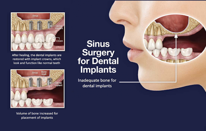 Sinus Lift | Dental Clinc in Yishun & Seng Kang