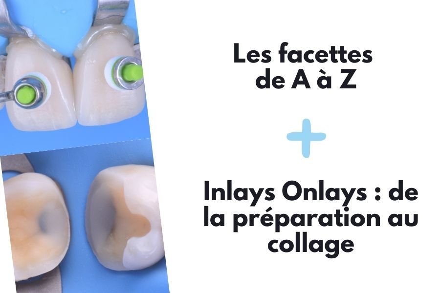 Découvrez notre pack restaurations indirectes 100% DPC