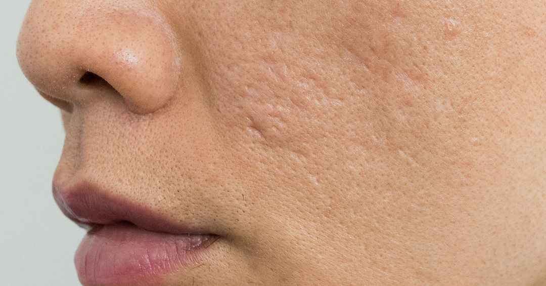 Scar Reduction - Atlantic Skin Care Dermatology Clinic, Nova Scotia