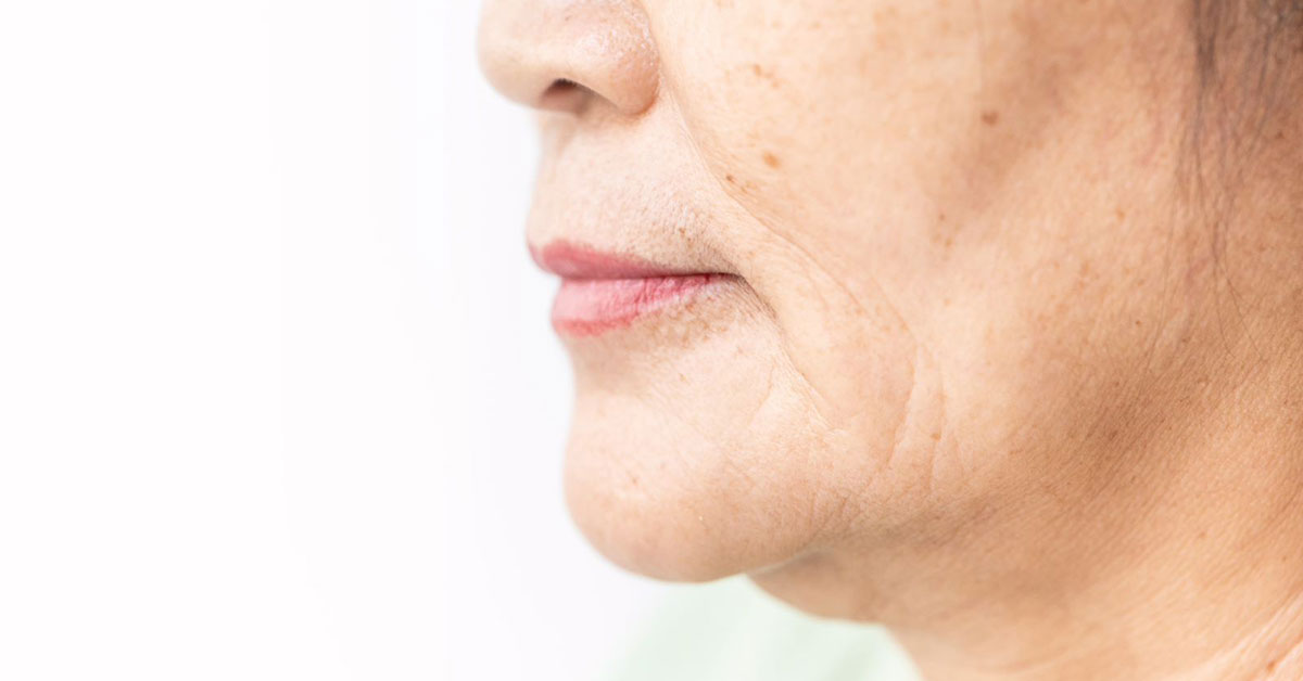 Treating Loose Skin - Atlantic Skin Care Dermatology Clinic, Nova Scotia