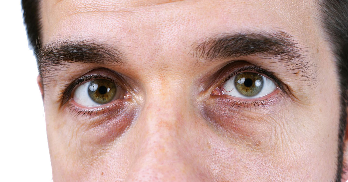 Treating Under Eye Dark Circles - Atlantic Skin Care Dermatology Clinic ...