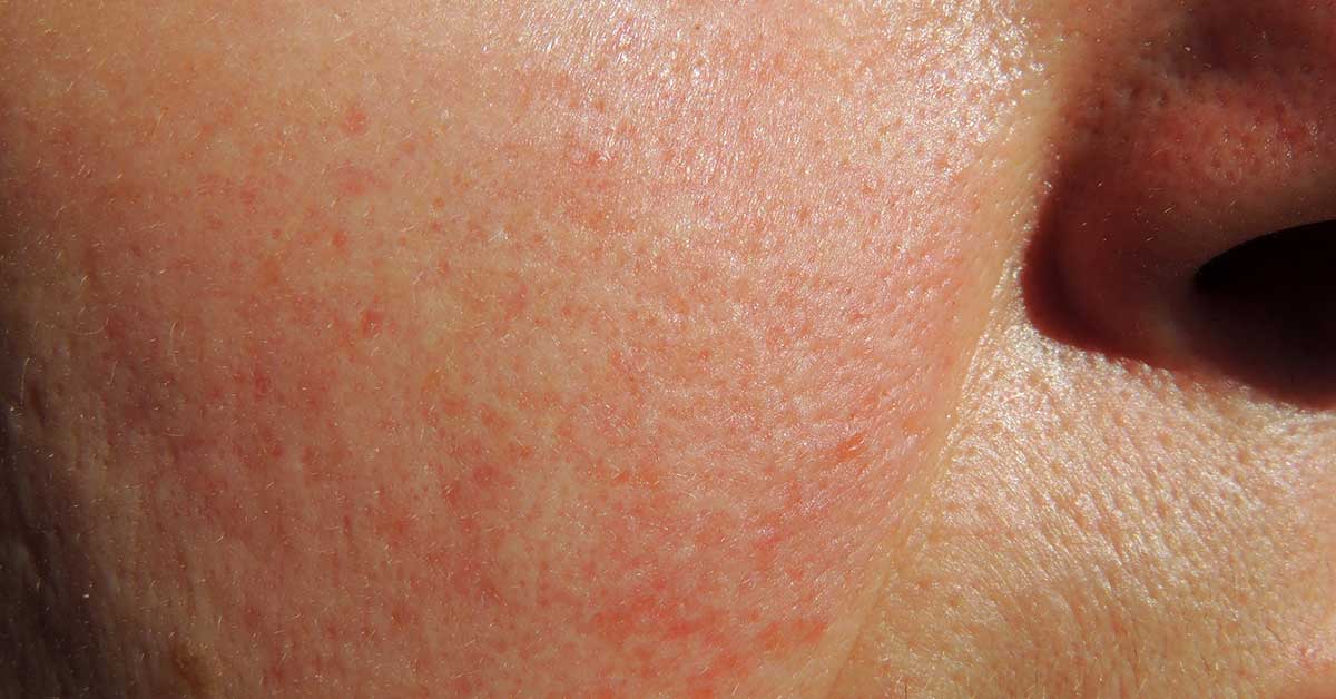 Treating Redness & Rosacea - Atlantic Skin Care Dermatology Clinic ...