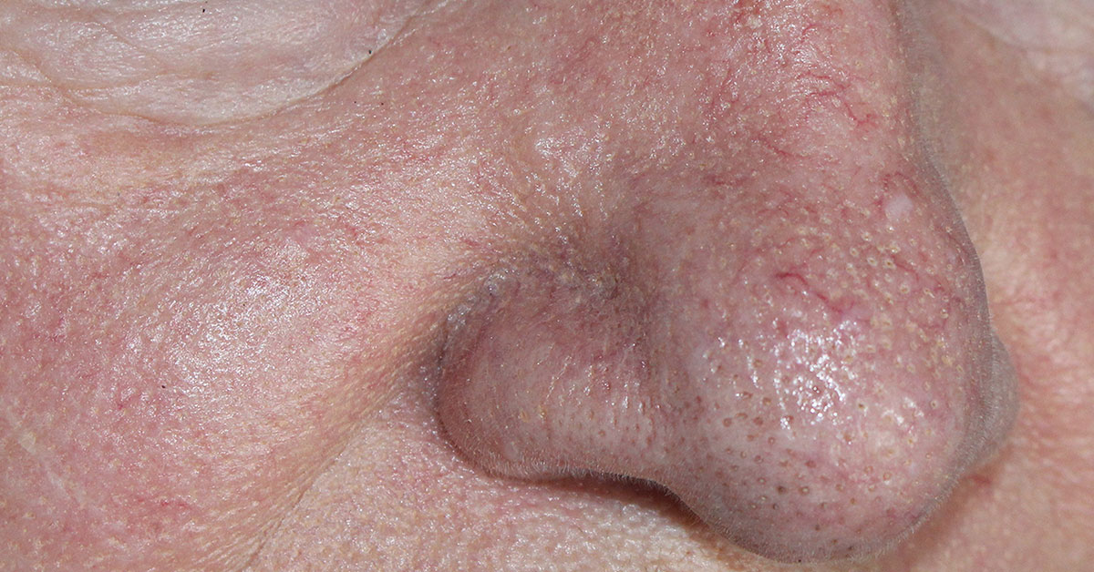 Treating Facial Veins - Atlantic Skin Care Dermatology Clinic, Nova Scotia