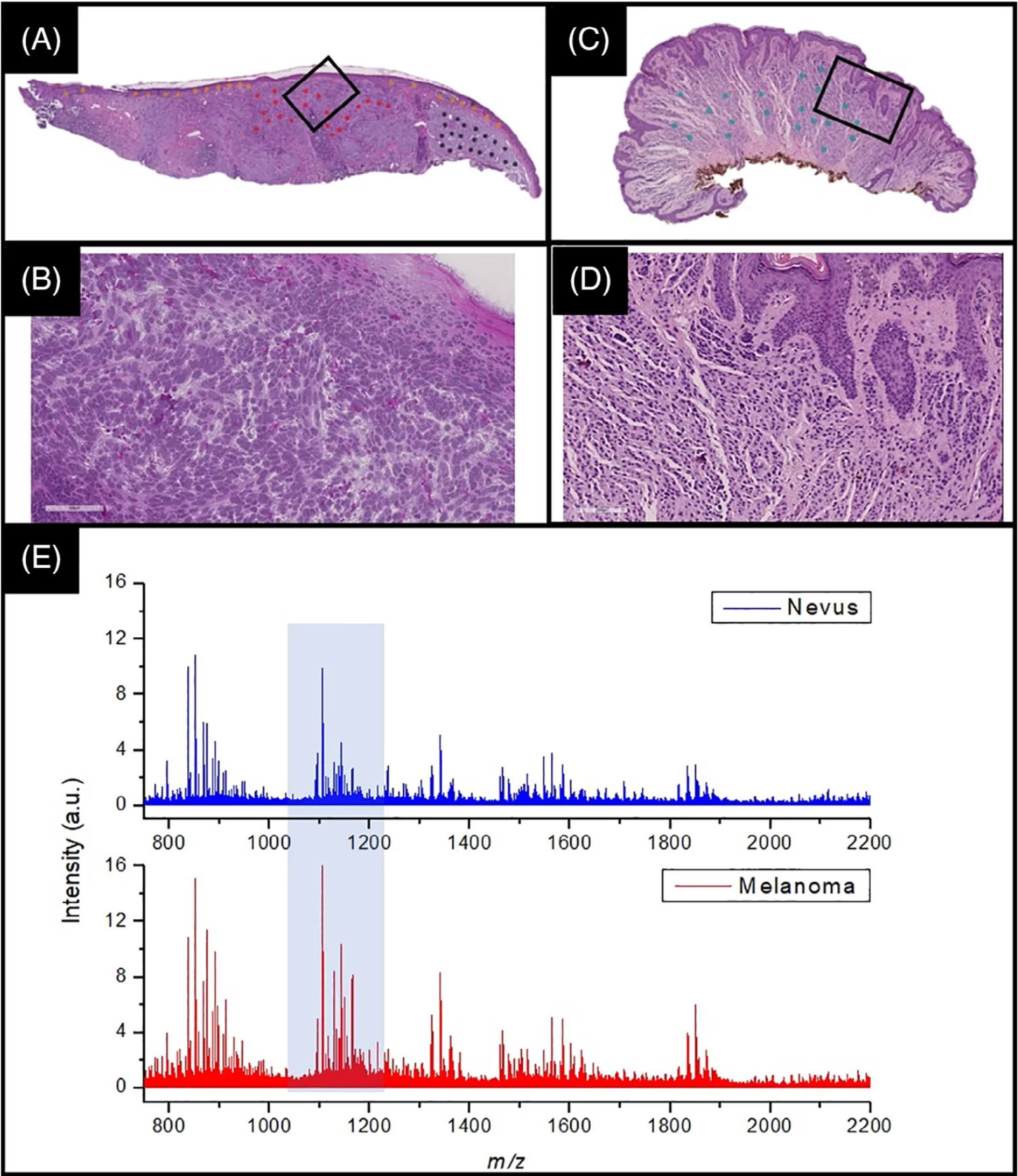 Diagnosis of melanoma by imaging mass spectrometry: Development and ...