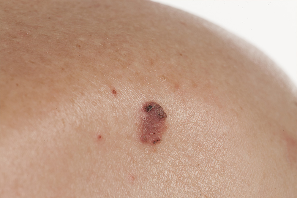 Skin Cancer + Mohs Surgery | Manhattan Dermatology