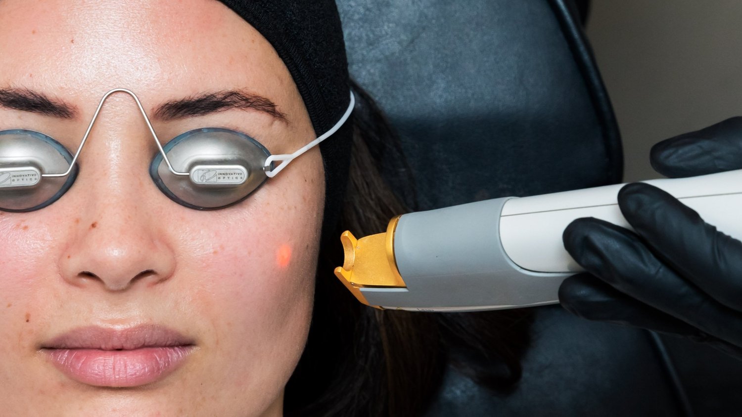 Excel V™ Laser | Manhattan Dermatology