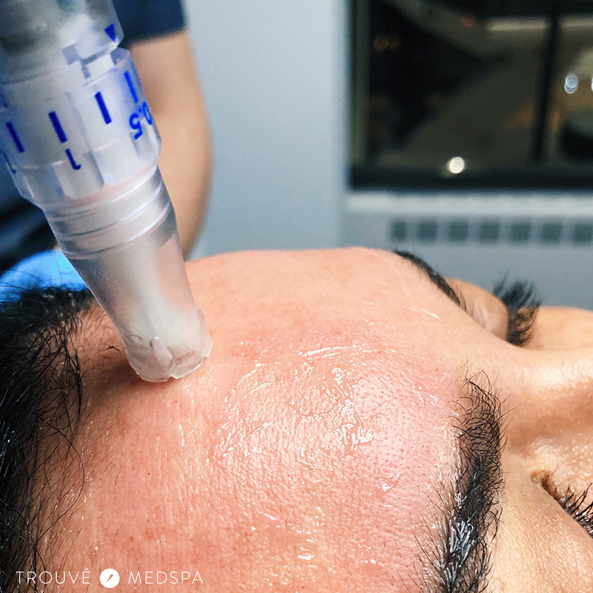 Microneedling Collagen Stimulation | Manhattan Dermatology