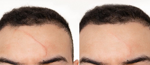 Scar Treatments | Manhattan Dermatology