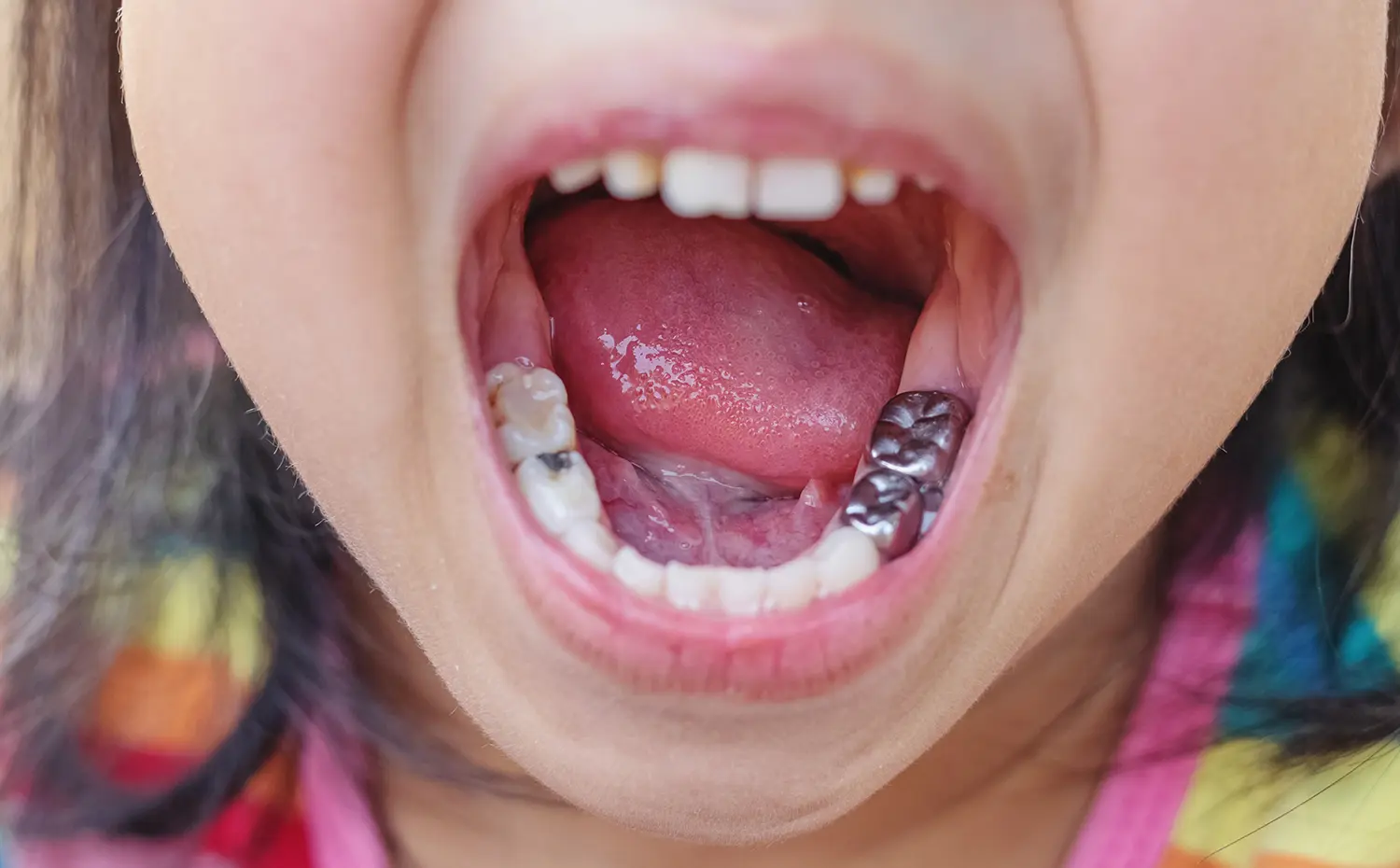 Zirconia Crowns | Shine Pediatric Dental Co.