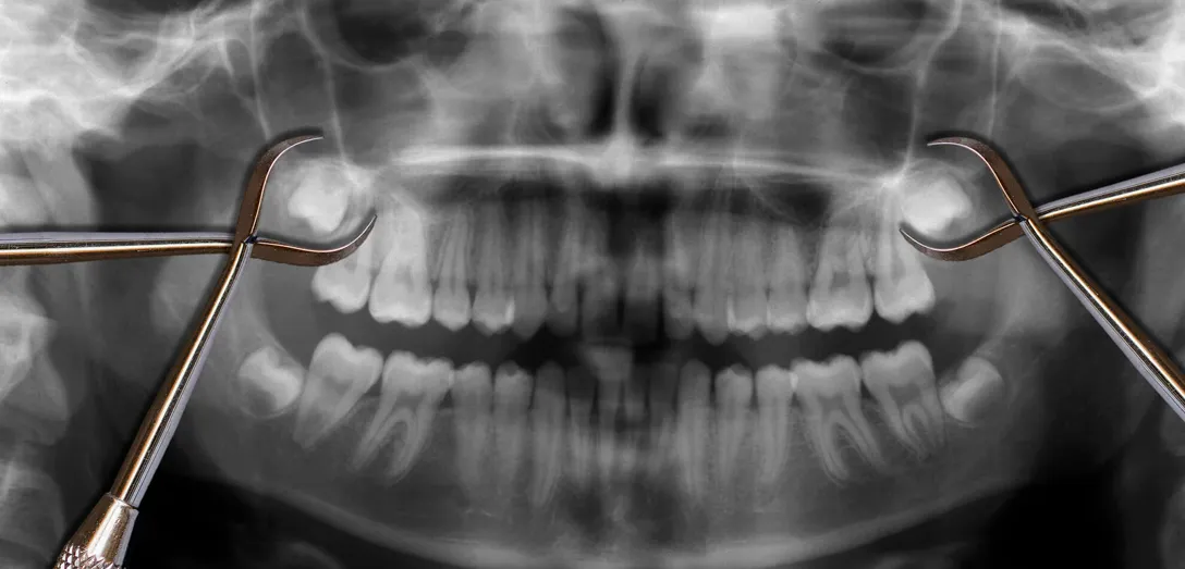 Wisdom Tooth Extraction Palm Springs | Wisdom Teeth Removal