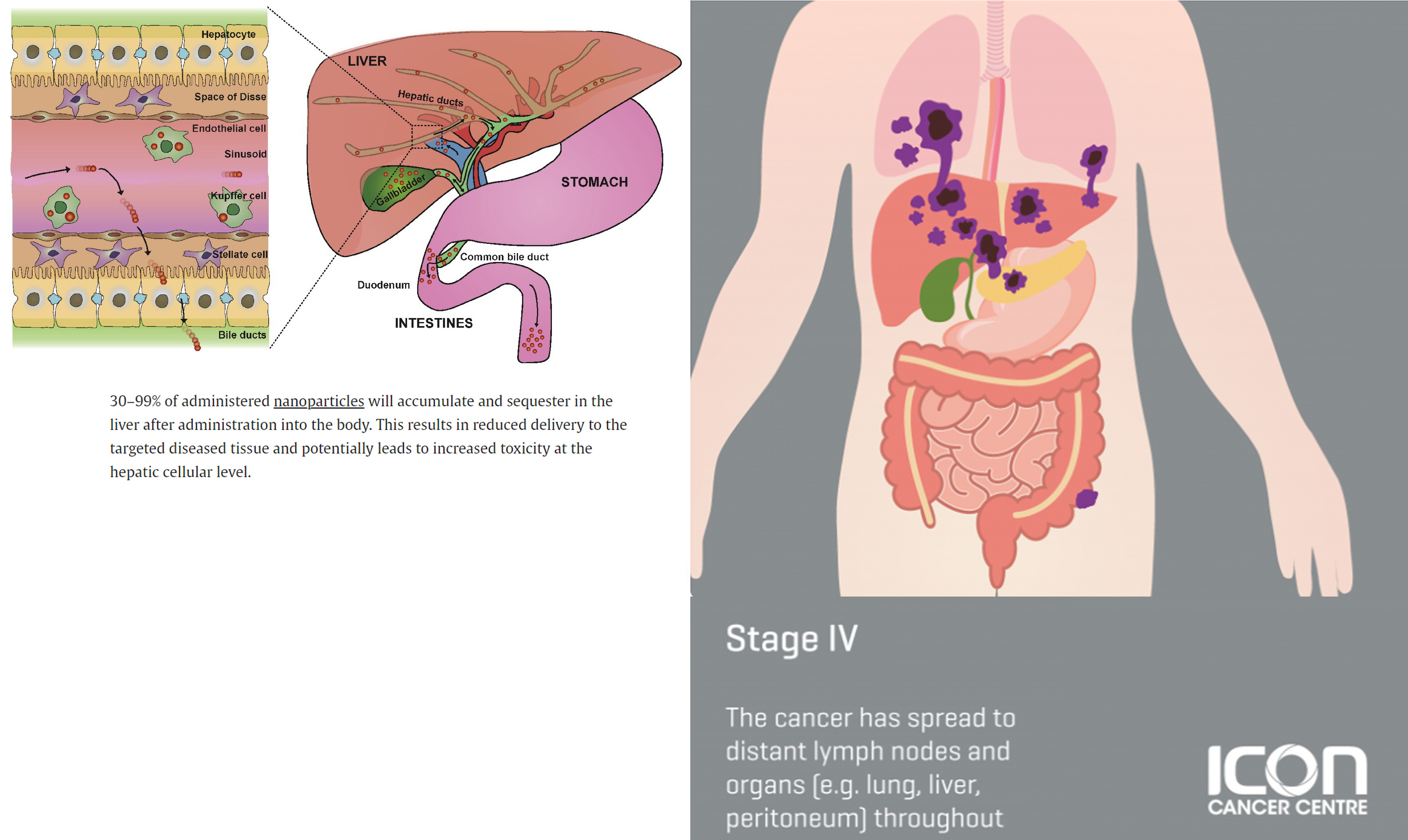 TURBO CANCER - Hepatobiliary System (Part 3) - Stage 4 COLON Cancer ...