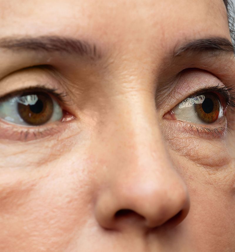 Under Eye Darkness & Puffiness - Optima Medical Cosmetic Clinic