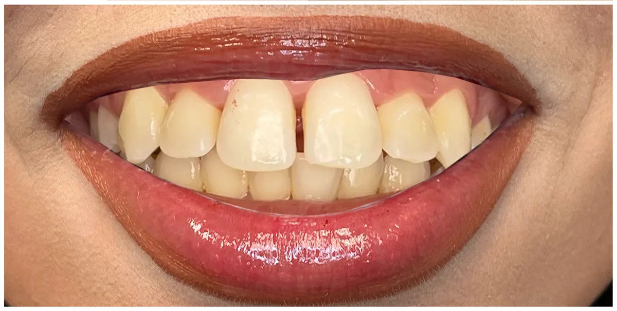 Orange County Cosmetic Dentist and Veneer Specialist : Transformative ...