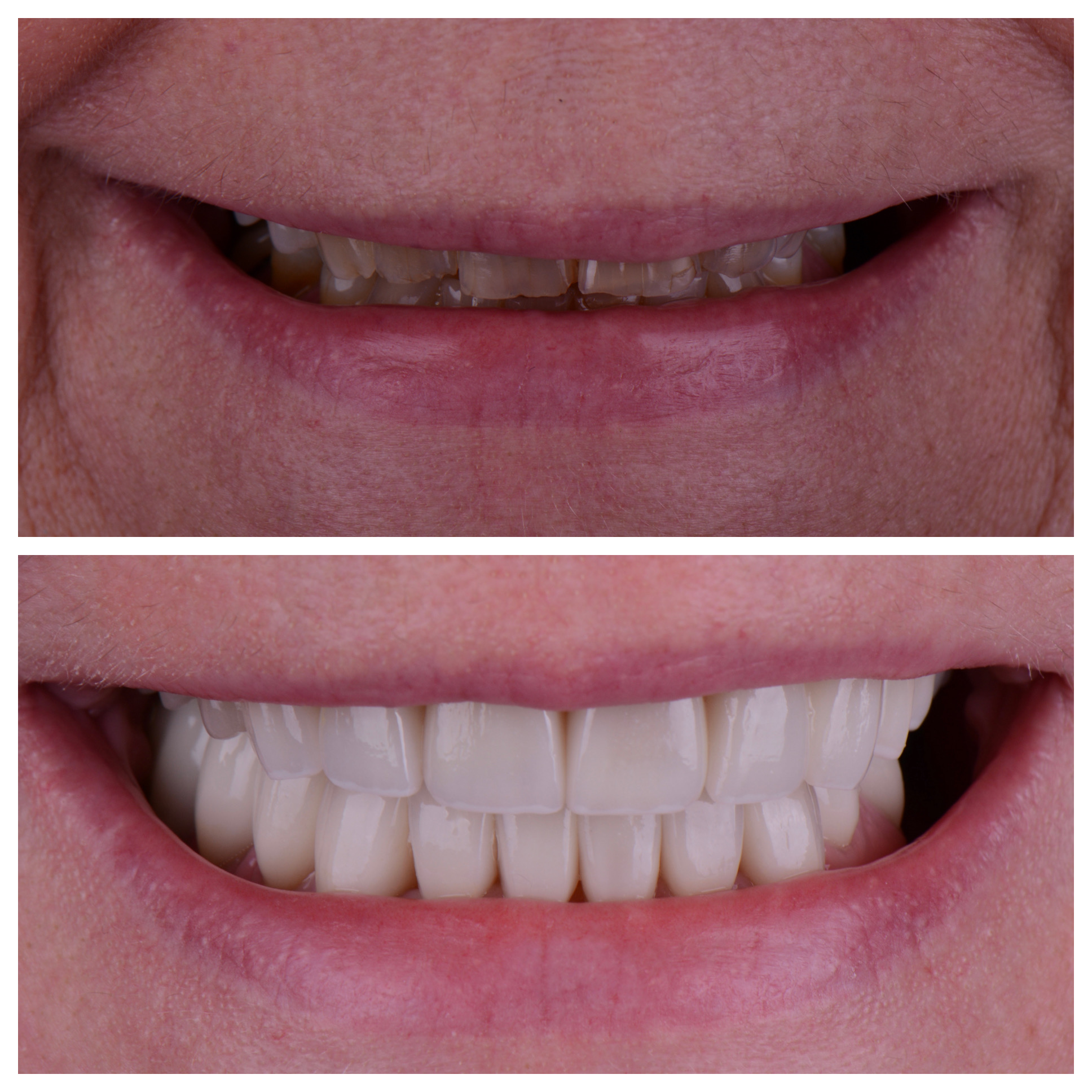 Before & Afters | Hudson Dental Co.