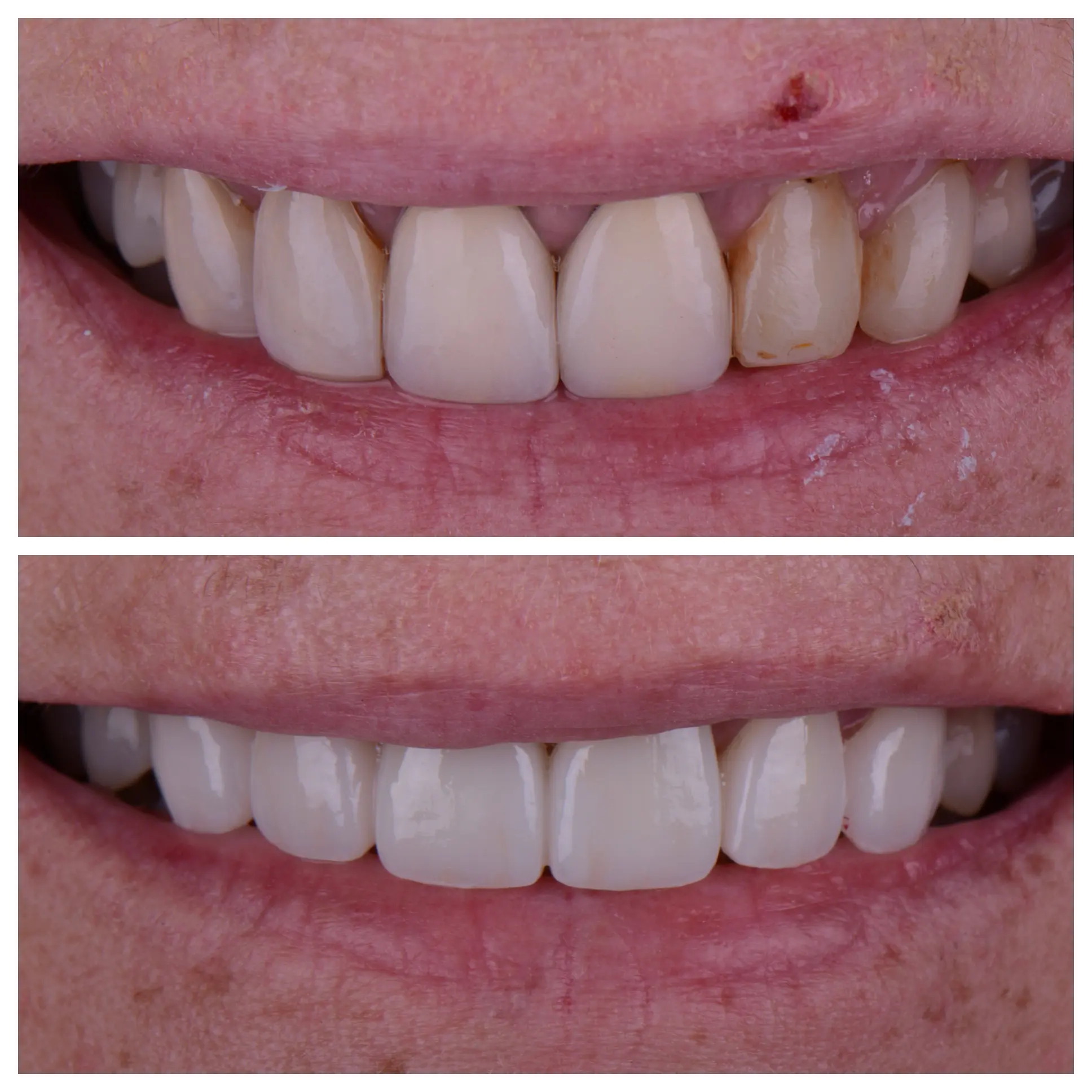 Before & Afters | Hudson Dental Co.