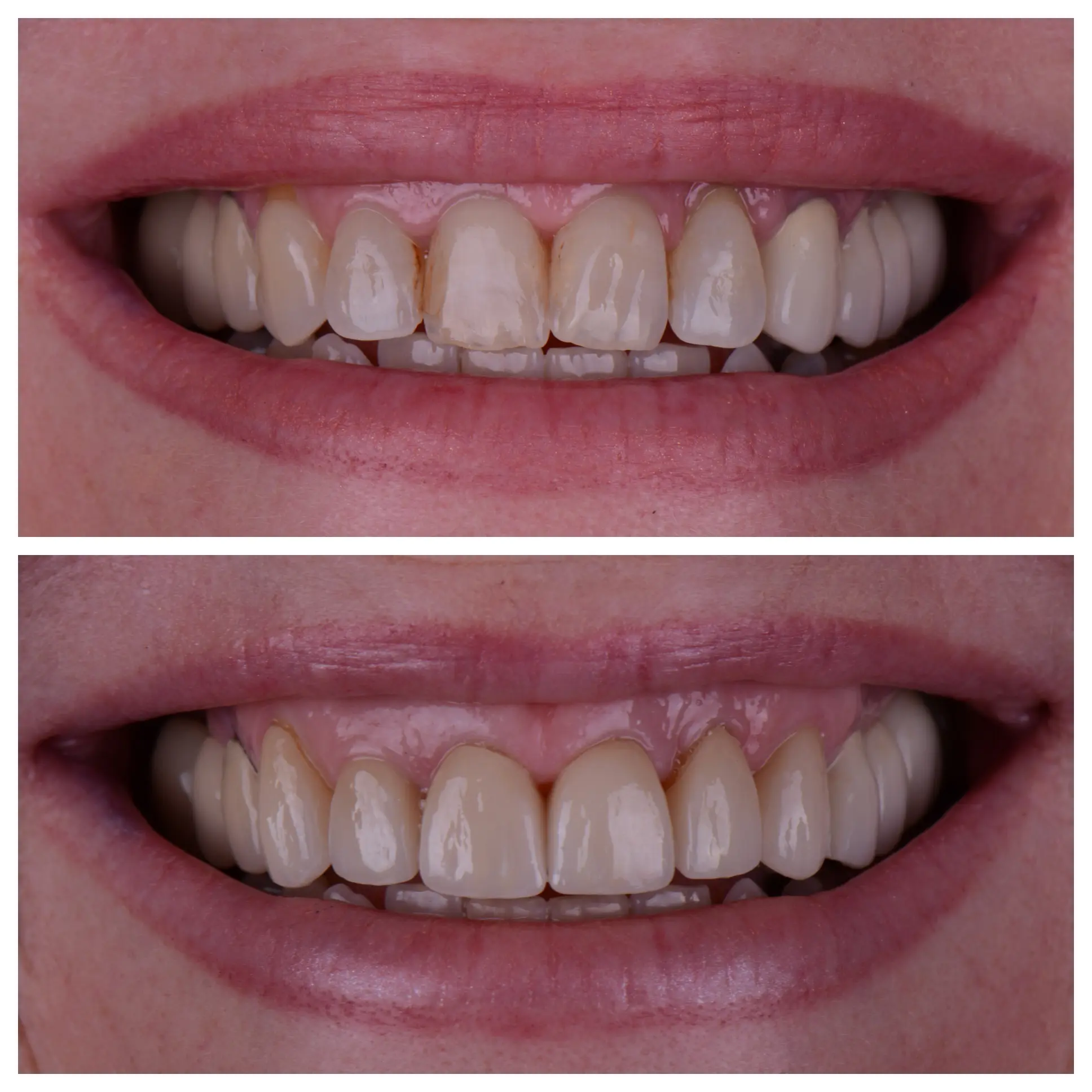 Before & Afters | Hudson Dental Co.