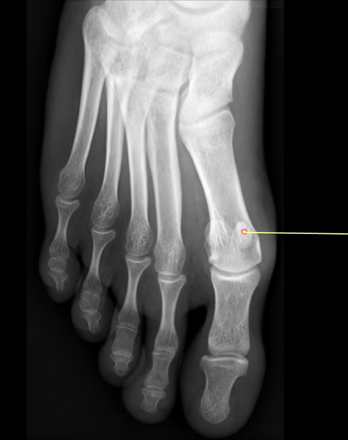 Podiatry Blog: Insights, Tips, and Expert Advice | LEAP Foot and Ankle ...