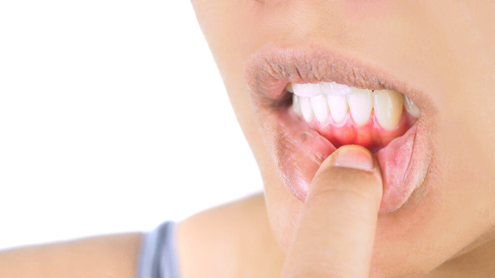 Can You Reverse Gum Disease?