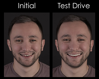 Test Drive Your New Smile| 4 steps | Netherlands | HDC Clinic