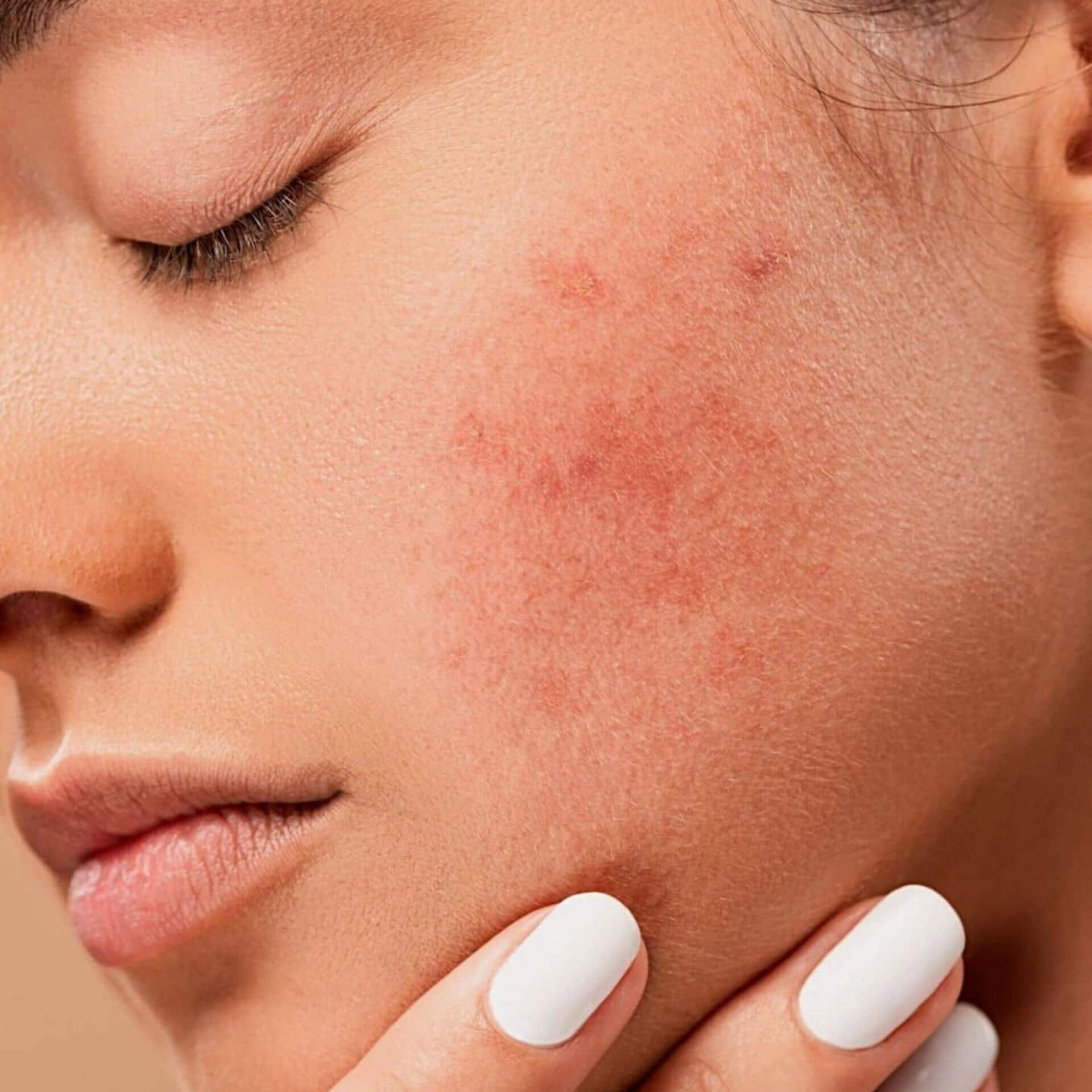 Rosacea & Redness | Renue Medical Spa