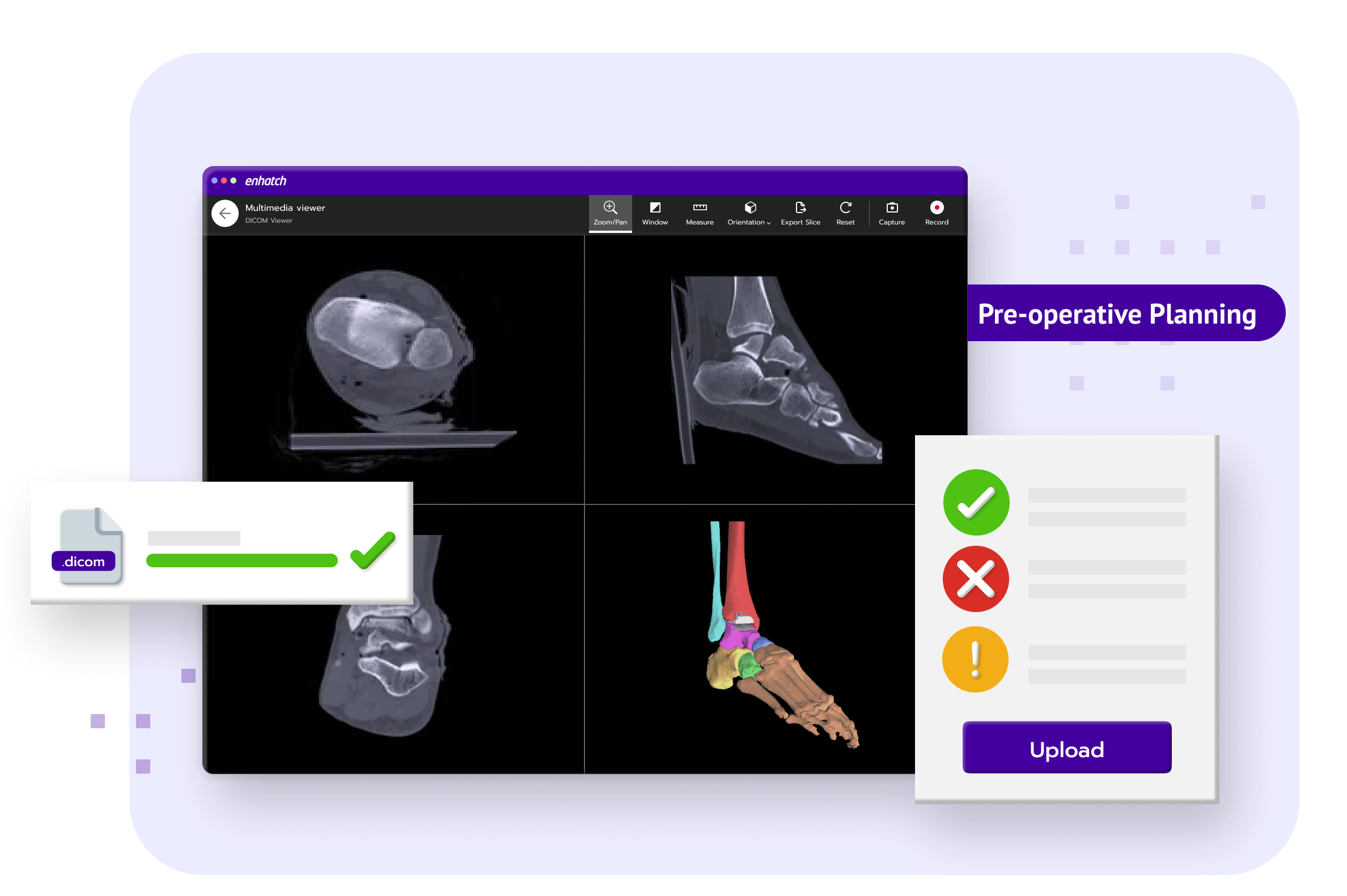 Enhatch: 3D planning for 3D printed implants and surgical guides