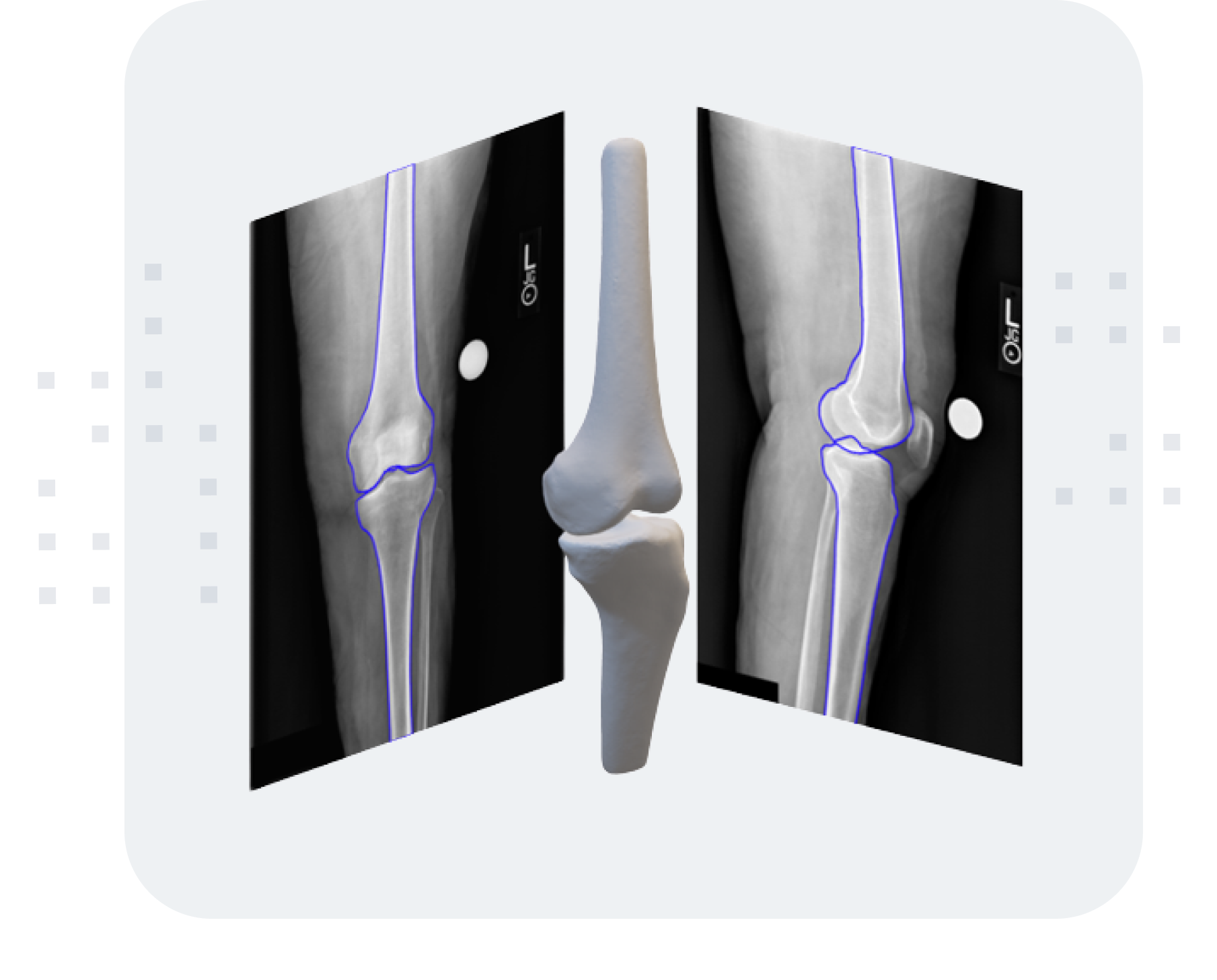 New era for knee 3D planning | Patient-specific surgical guides