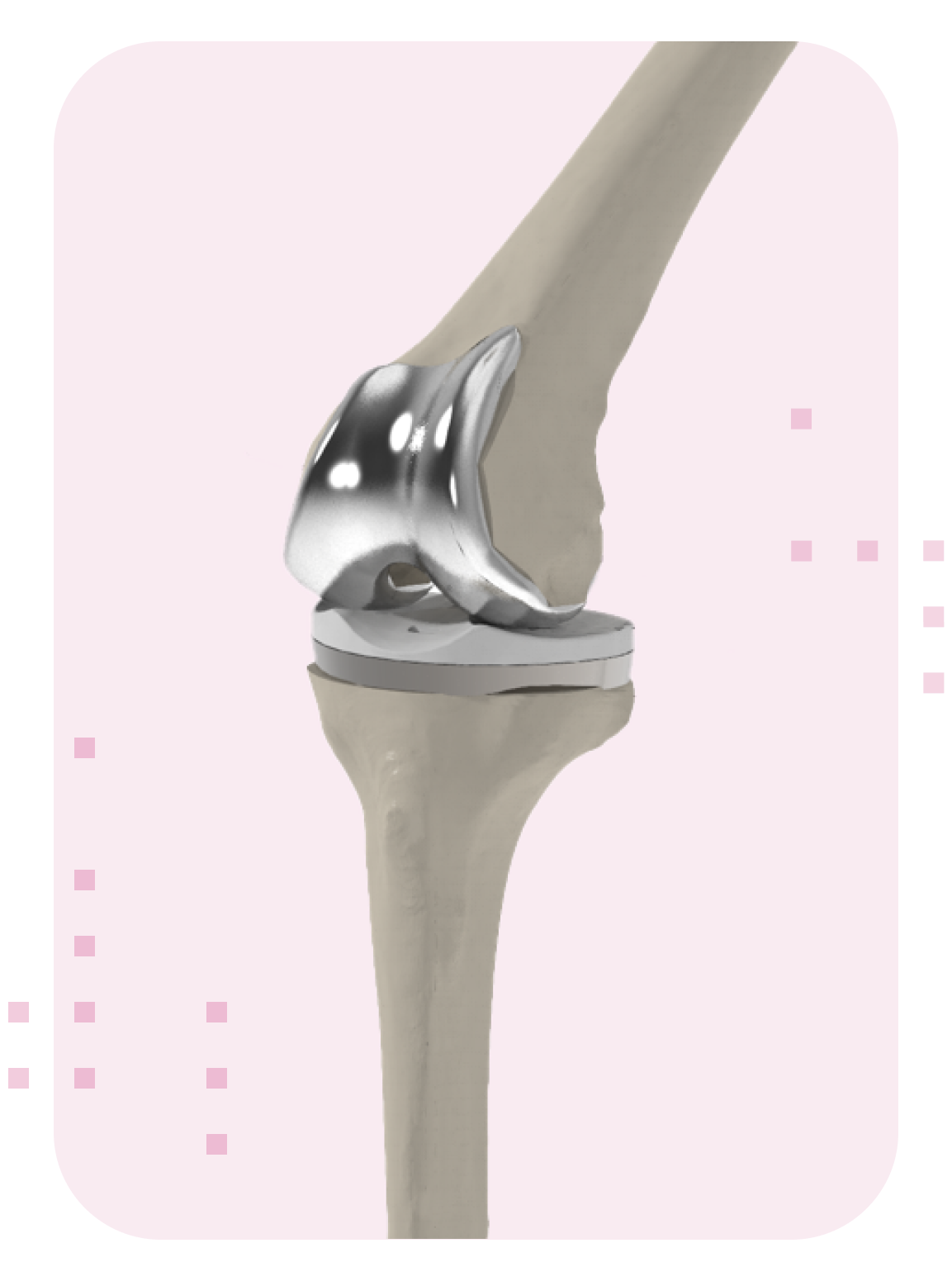 New era for knee 3D planning | Patient-specific surgical guides