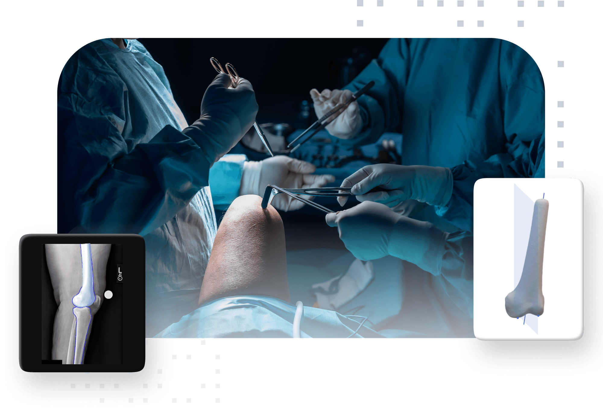 New era for knee 3D planning | Patient-specific surgical guides