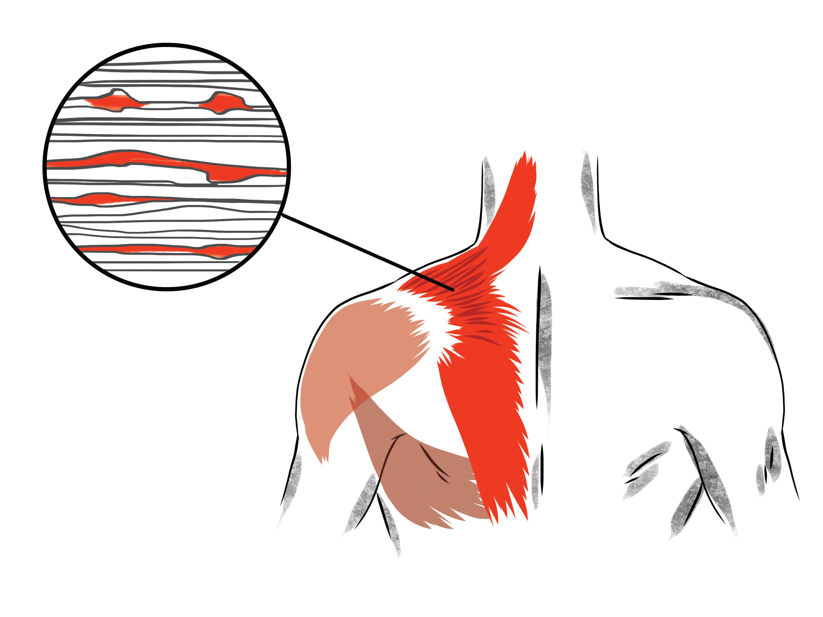 How To Get A Trapezius Knot Release