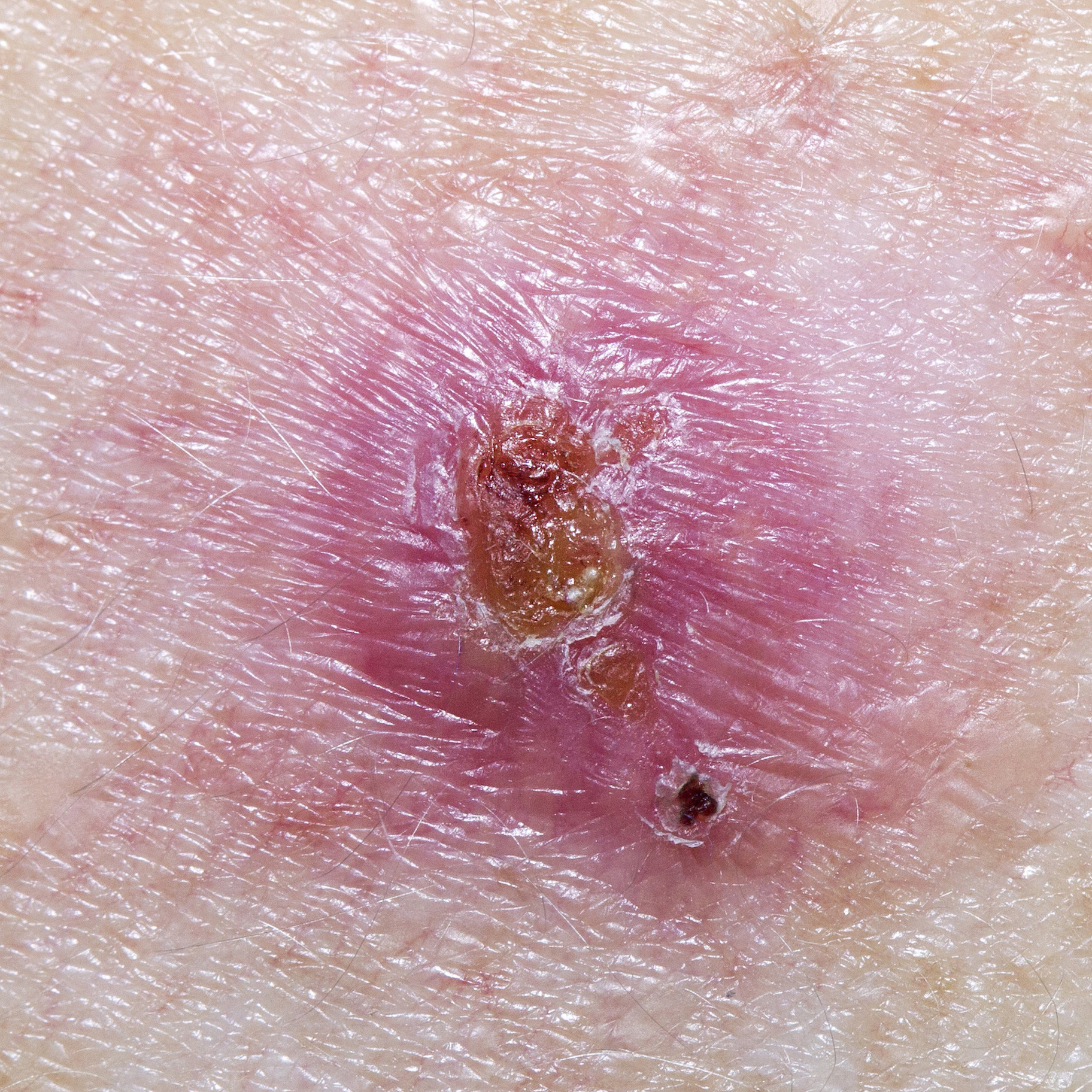 Basal Cell Carcinoma Removal & Treatment in Toronto