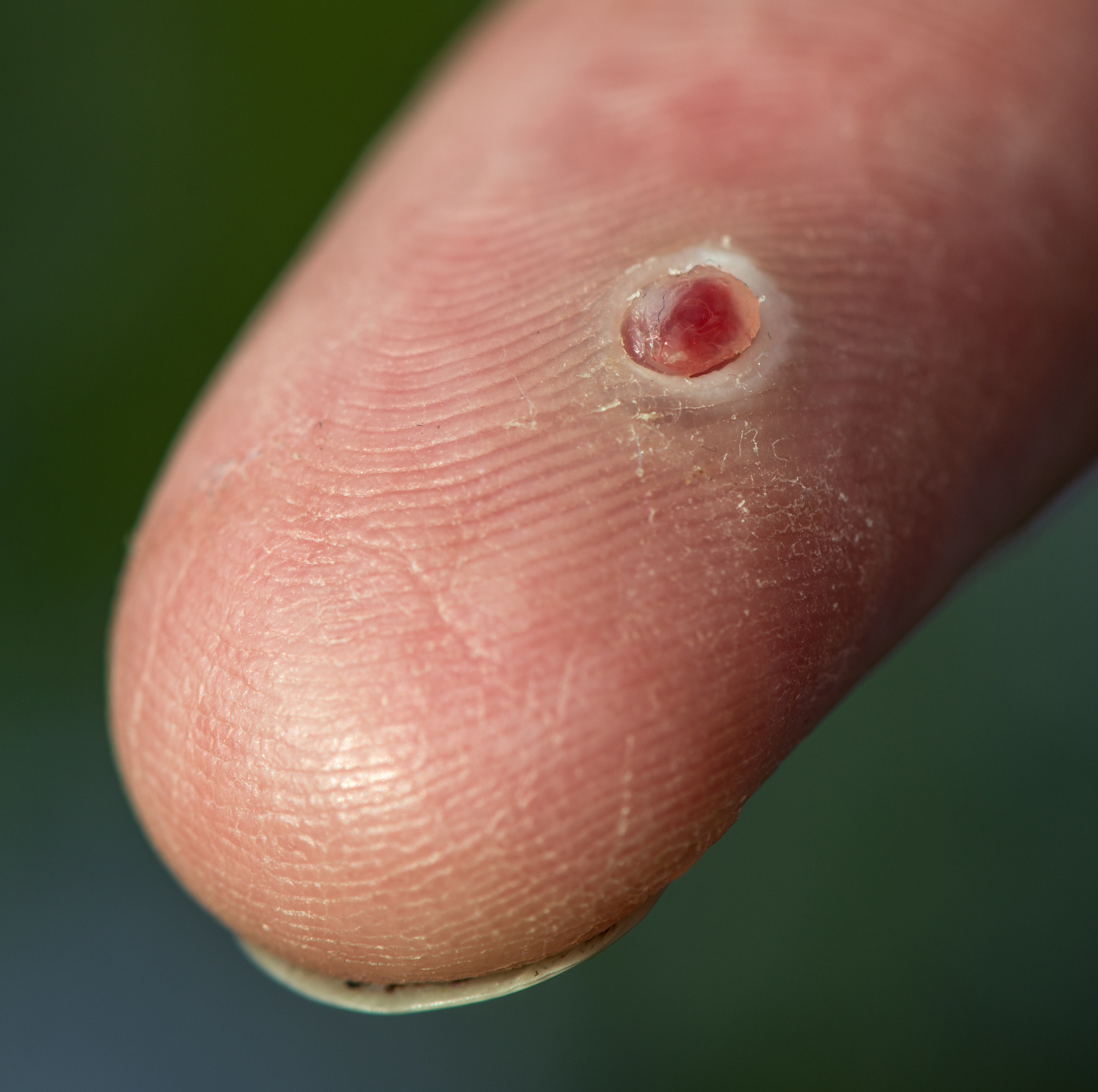 Pyogenic Granuloma Removal & Treatment in Toronto