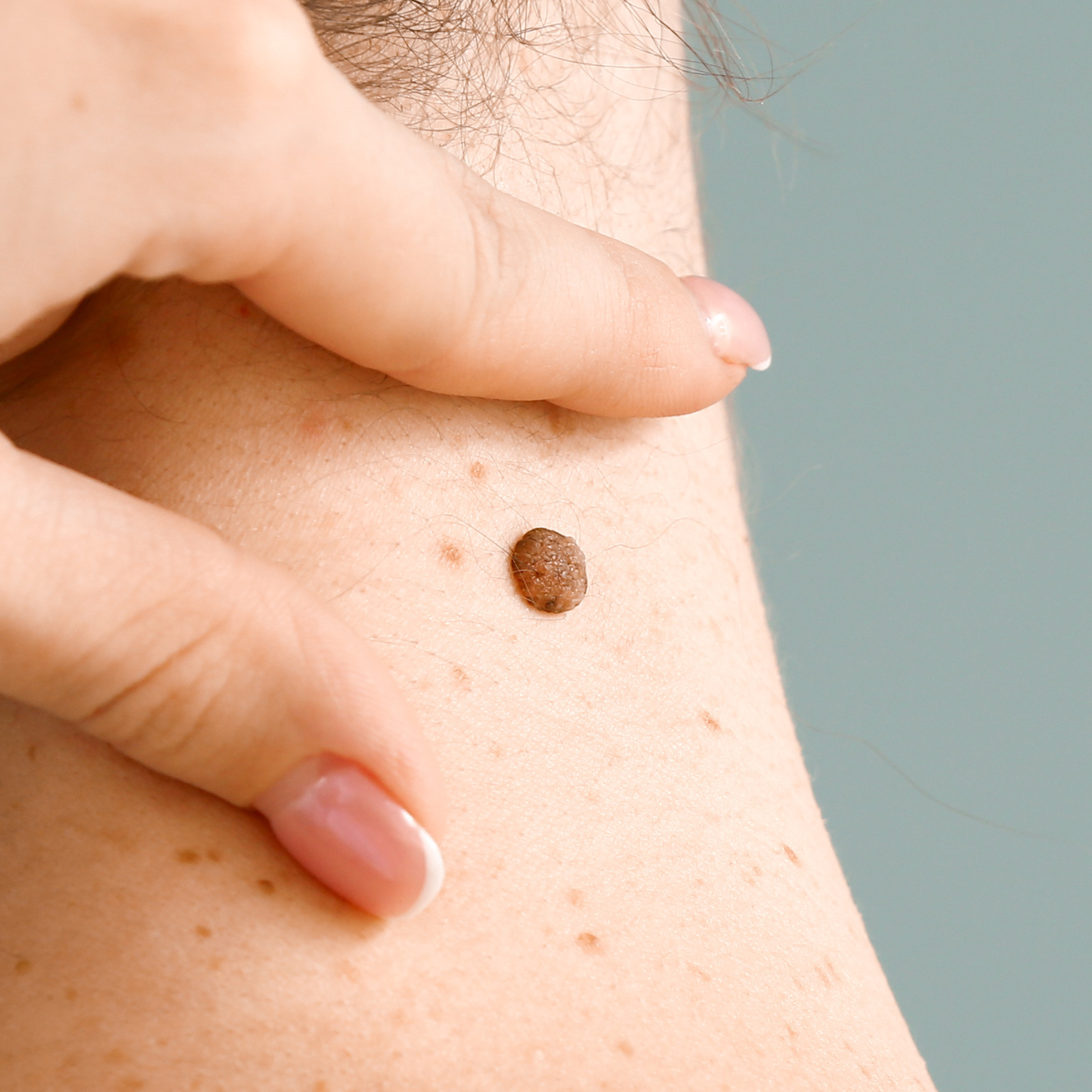 Mole Removal in Toronto | Mole Surgery & Treatment