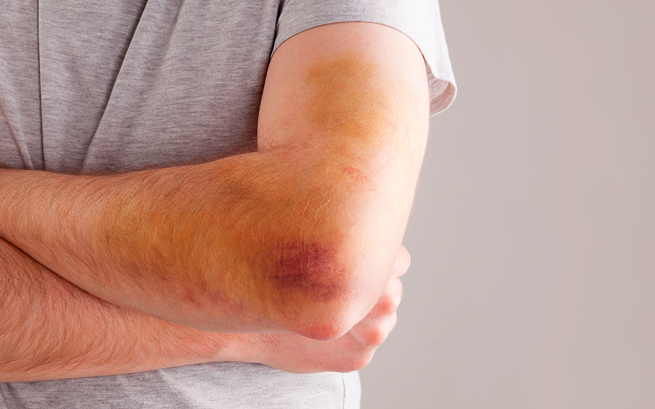 La terrible verdad de los moretes