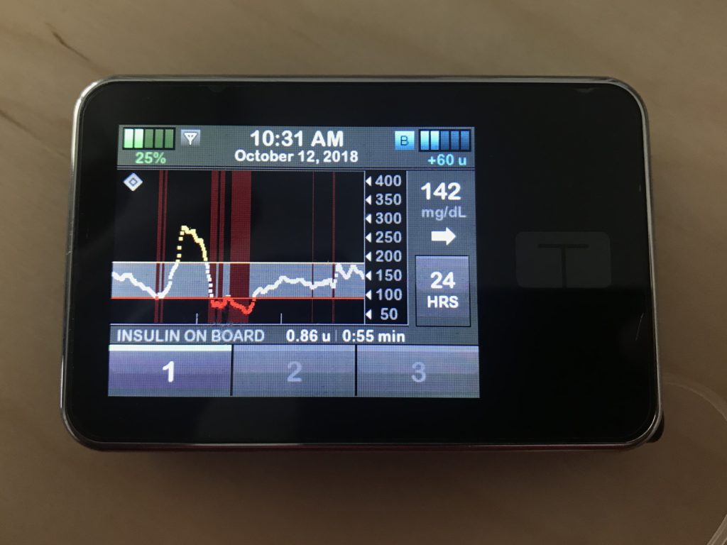 My first month running Basal-IQ | Tidepool