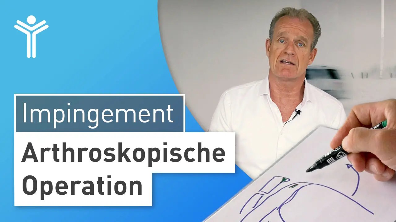 Impingement Syndrom | KLINIK am RING - Köln