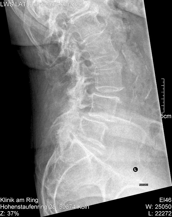IM FOKUS Magazin: Die segmentale Instabilität der Wirbelsäule