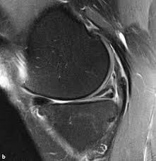 IM FOKUS Magazin: Meniskusläsion