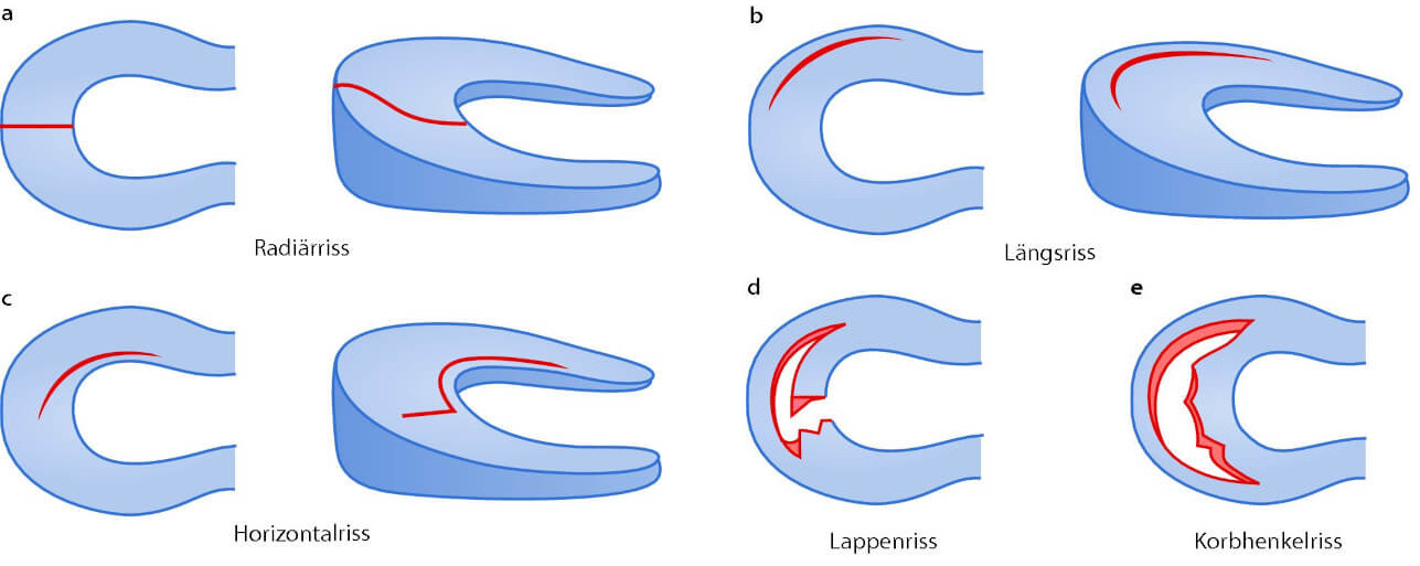 IM FOKUS Magazin: Meniskusläsion