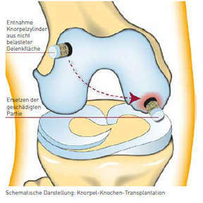 IM FOKUS Magazin: Kniegelenk: Knorpelschäden