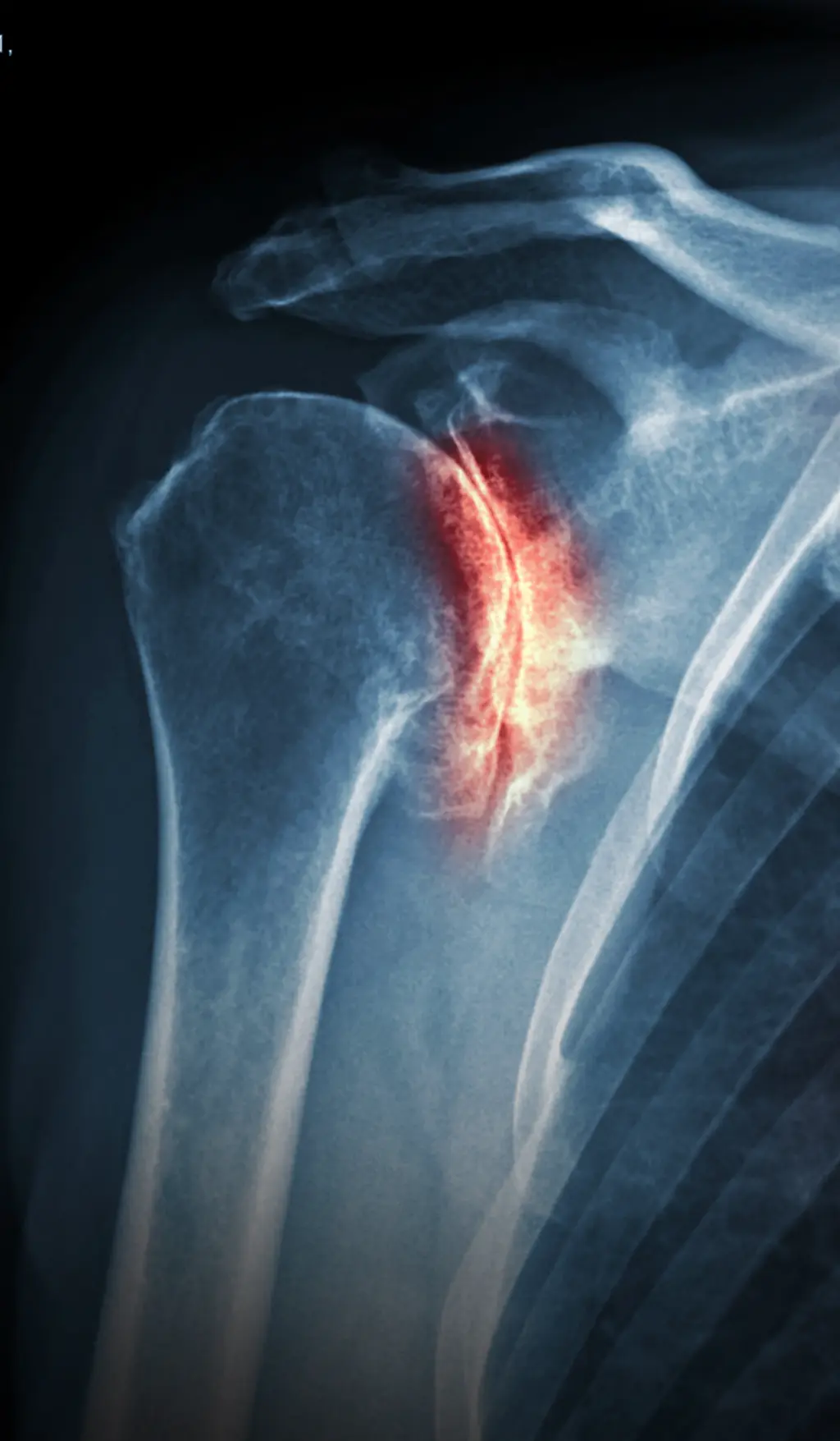 Omarthrose | KLINIK am RING - Köln