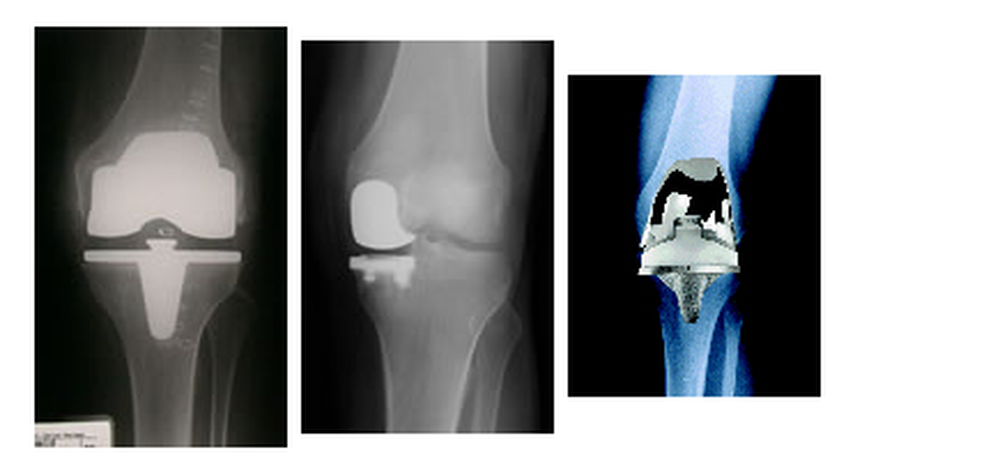 Knie-TEP | KLINIK am RING - Köln