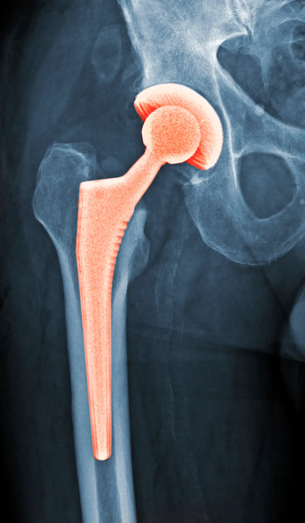 Hüft-TEP | KLINIK am RING - Köln