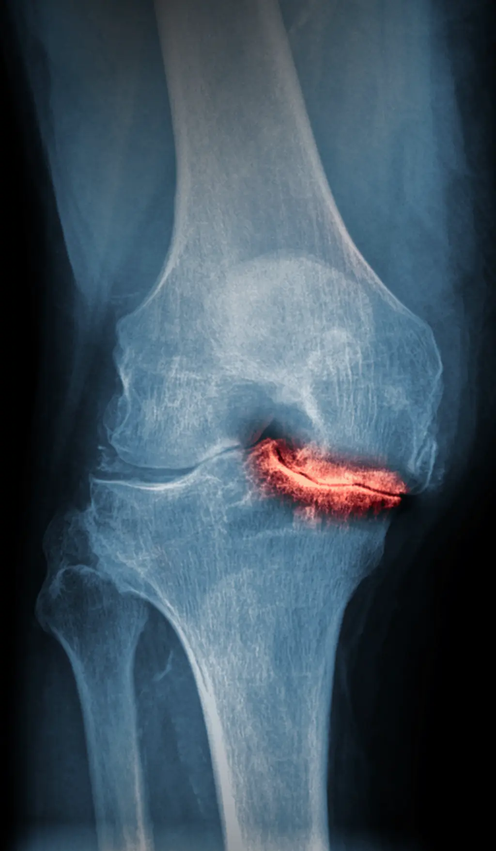 Gonarthrose | KLINIK am RING - Köln