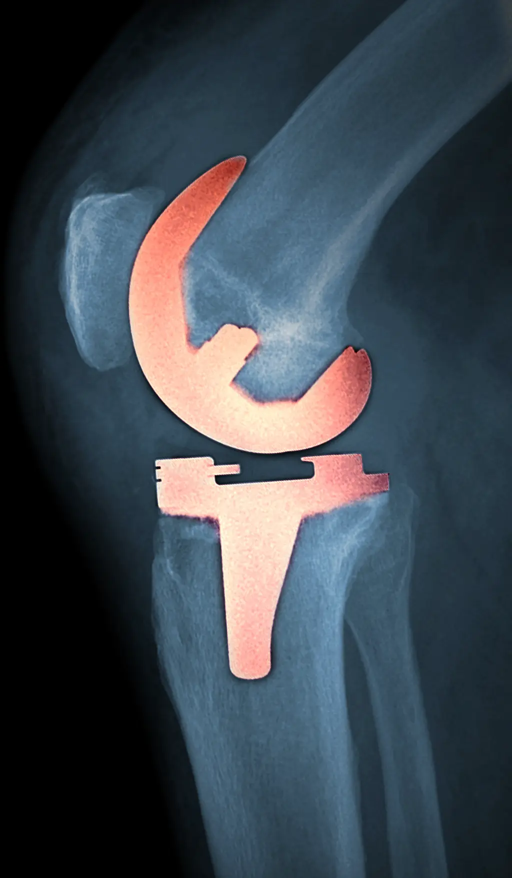 Knie-TEP | KLINIK am RING - Köln