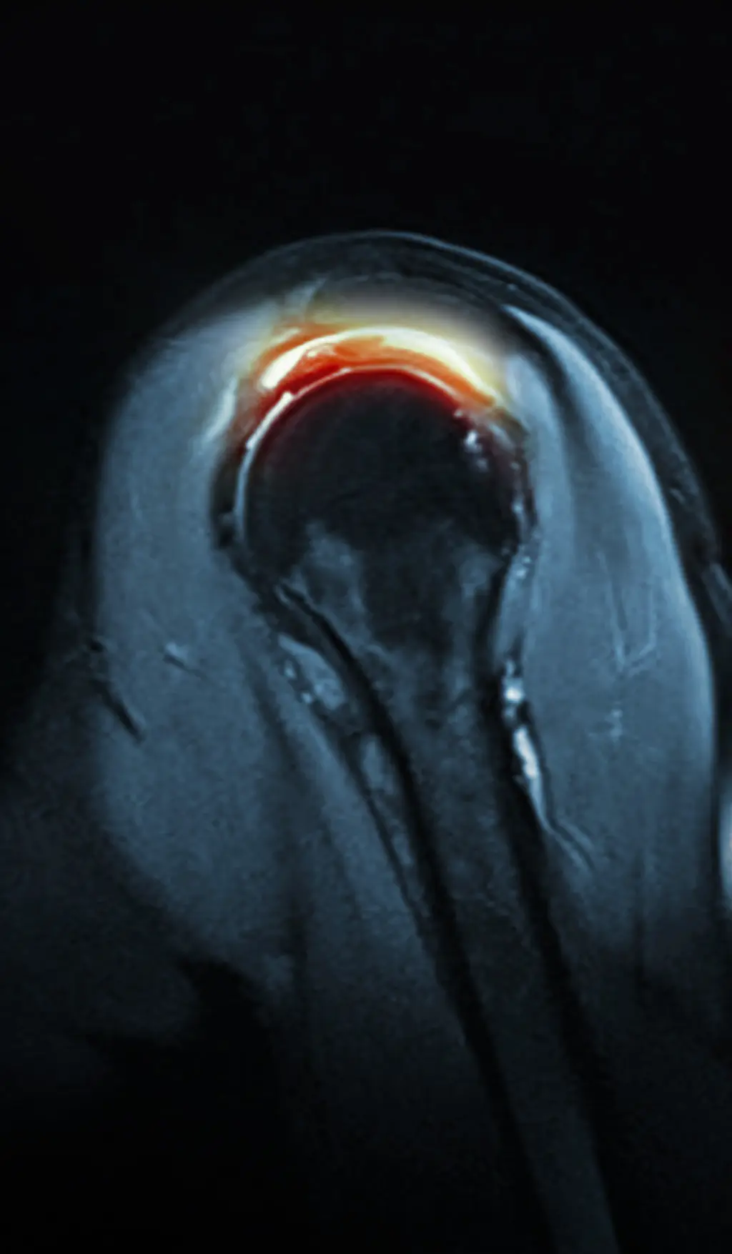 Impingement Syndrom | KLINIK am RING - Köln