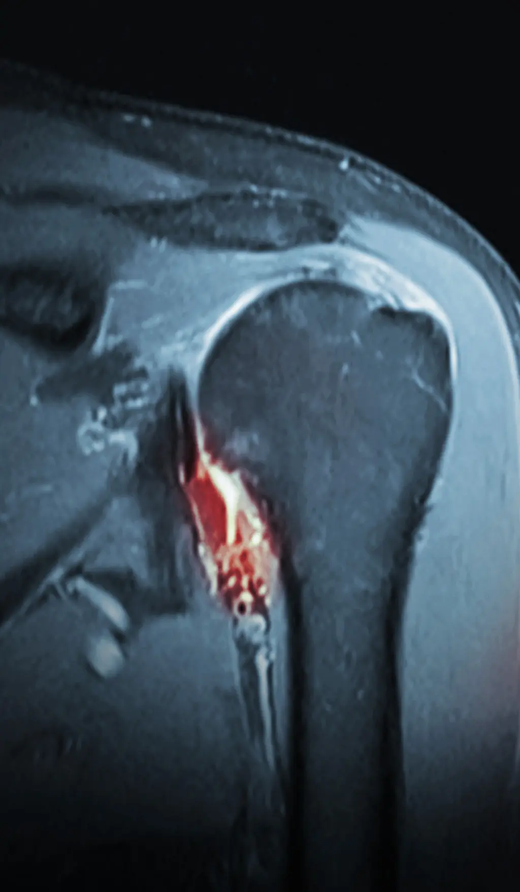 Frozen Shoulder | KLINIK am RING - Köln