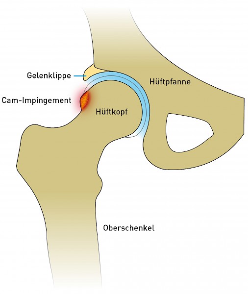 Hüftimpingement | KLINIK am RING - Köln